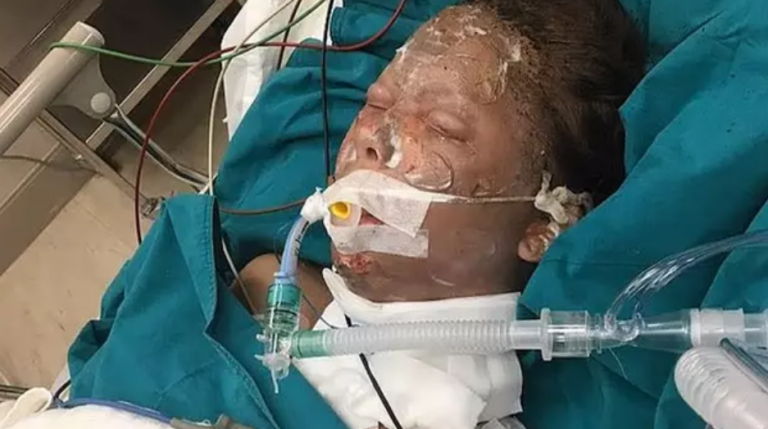 Ohio Burn Survivor Shares Incredible 6-Year Recovery Journey - The ...